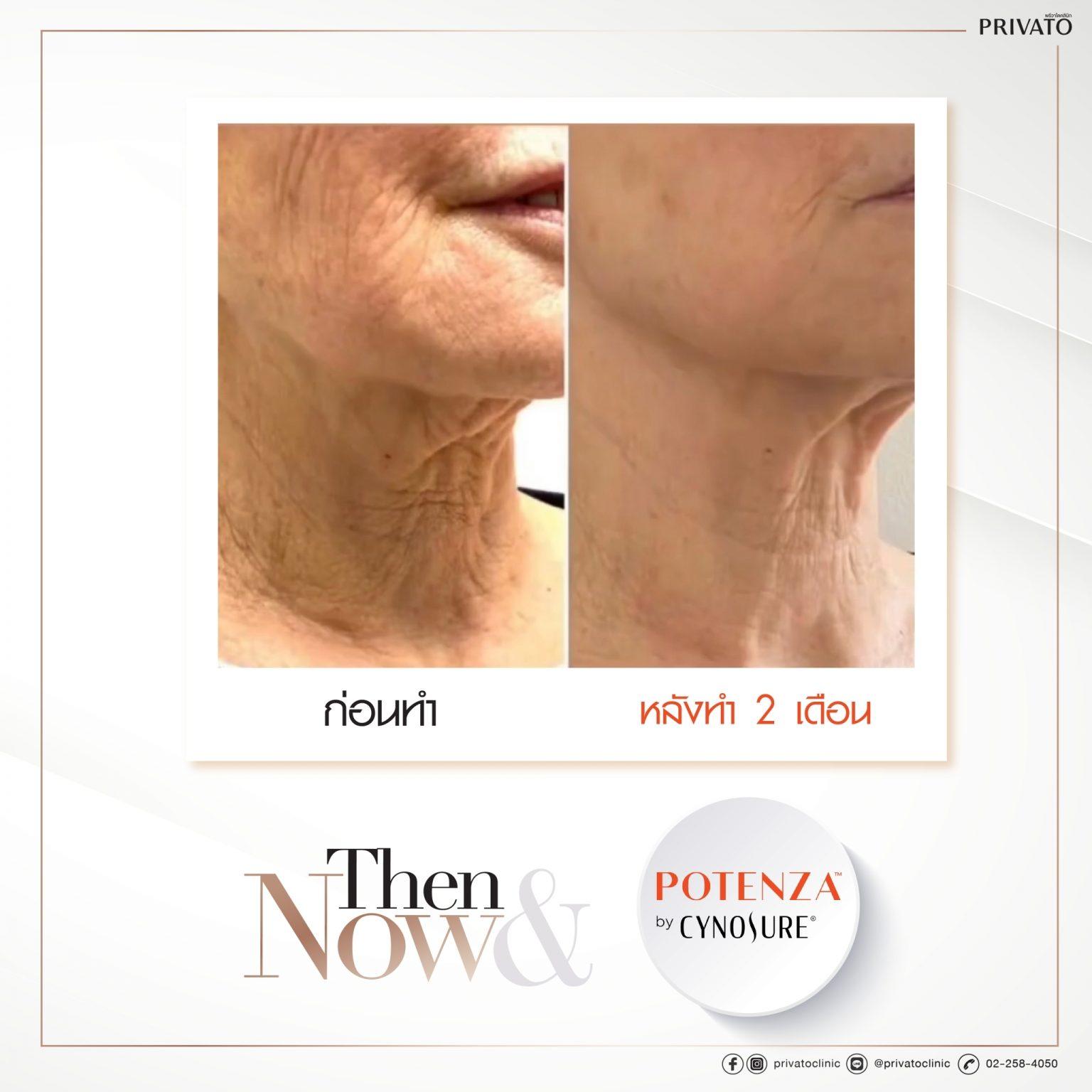 What is Potenza Treatment?