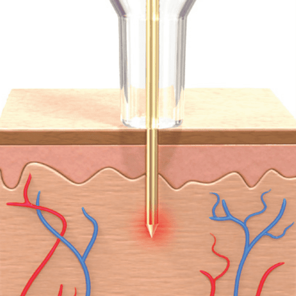 Potenza นวัตกรรมเลเซอร์เข็มทองคำ กระชับผิว - Privato Clinic