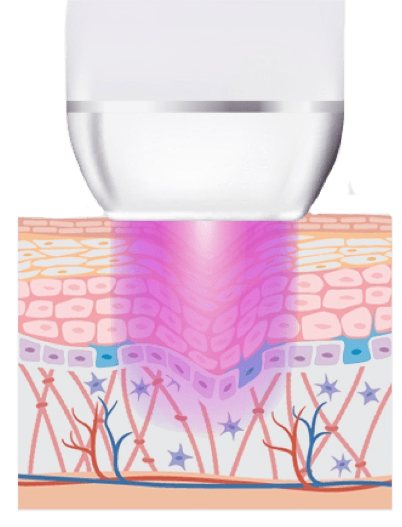 Thermage FLX - eng - Privato Clinic - Innovation Of Beauty | Bangkok